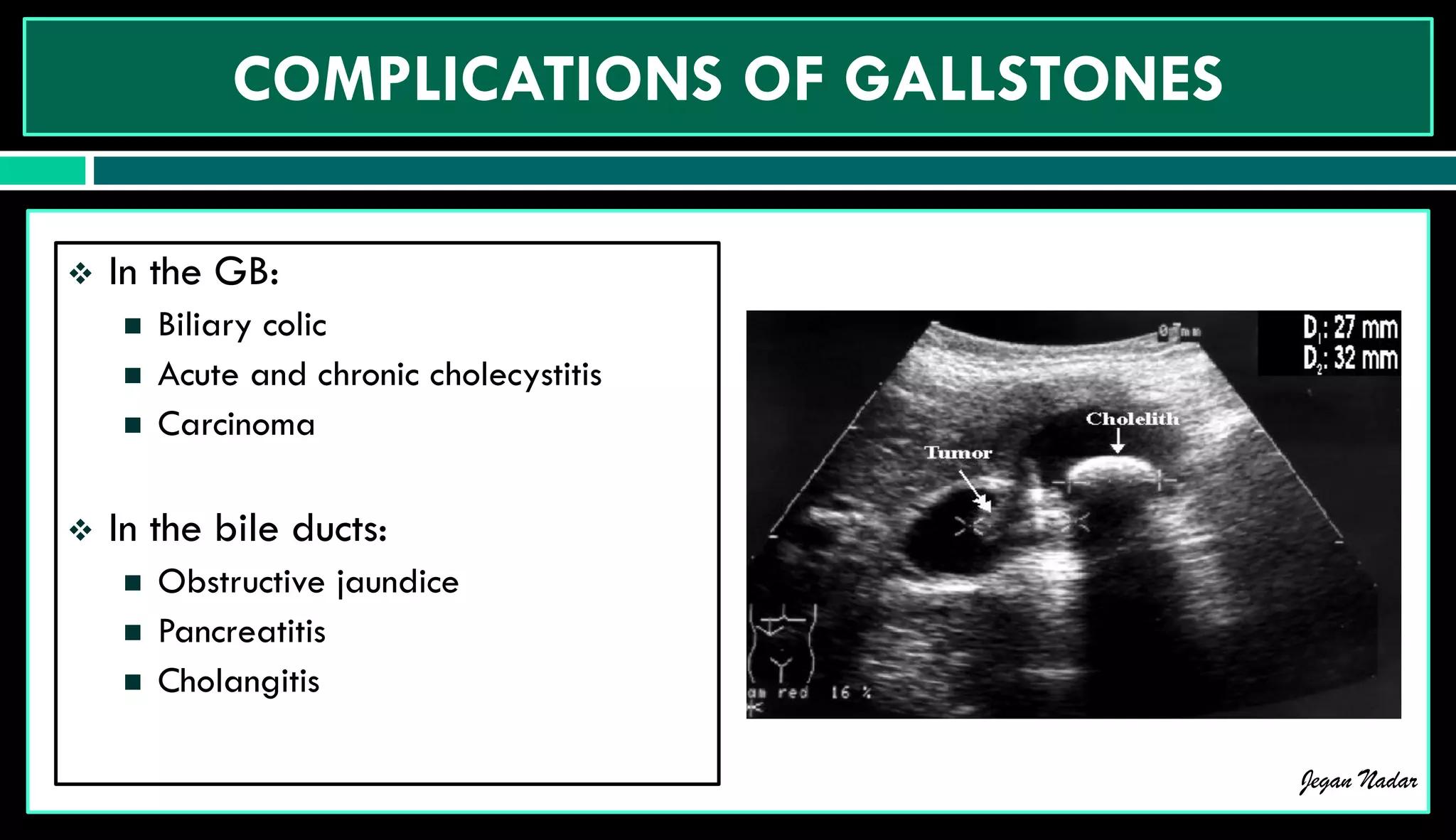 Pathophysiology of Cholecystitis and cholelithiasis | PDF