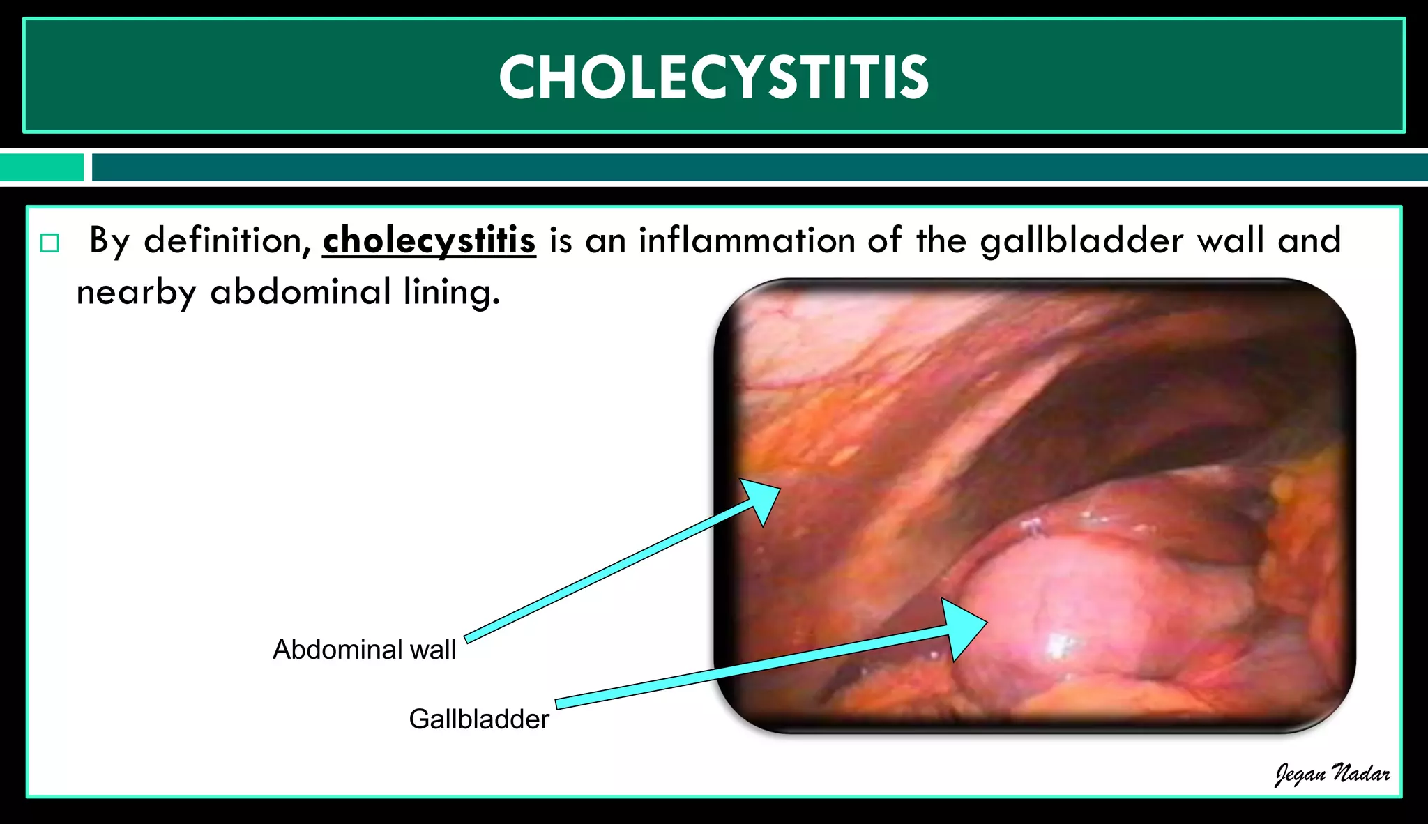 Pathophysiology of Cholecystitis and cholelithiasis | PDF