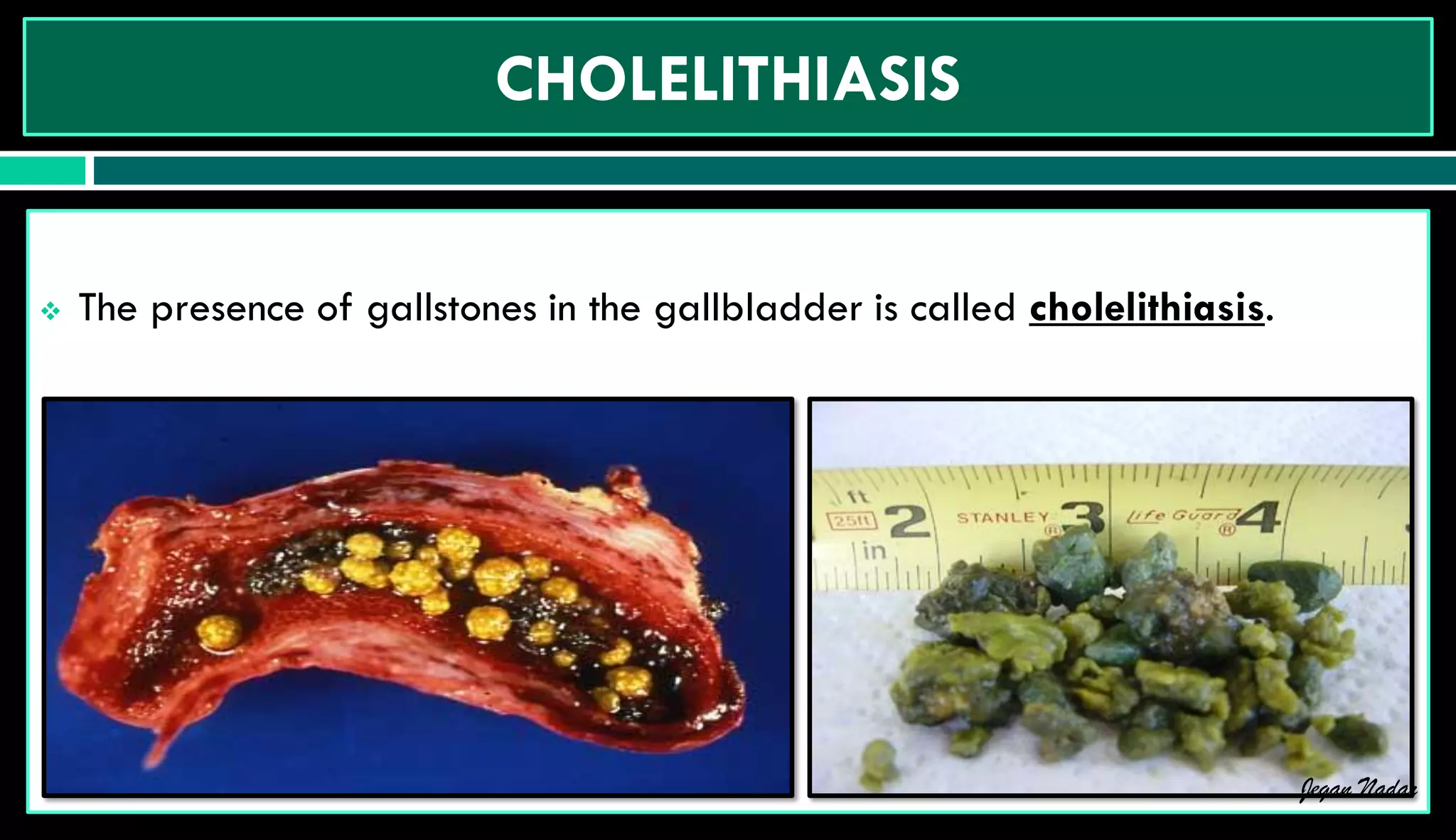 Pathophysiology of Cholecystitis and cholelithiasis | PDF