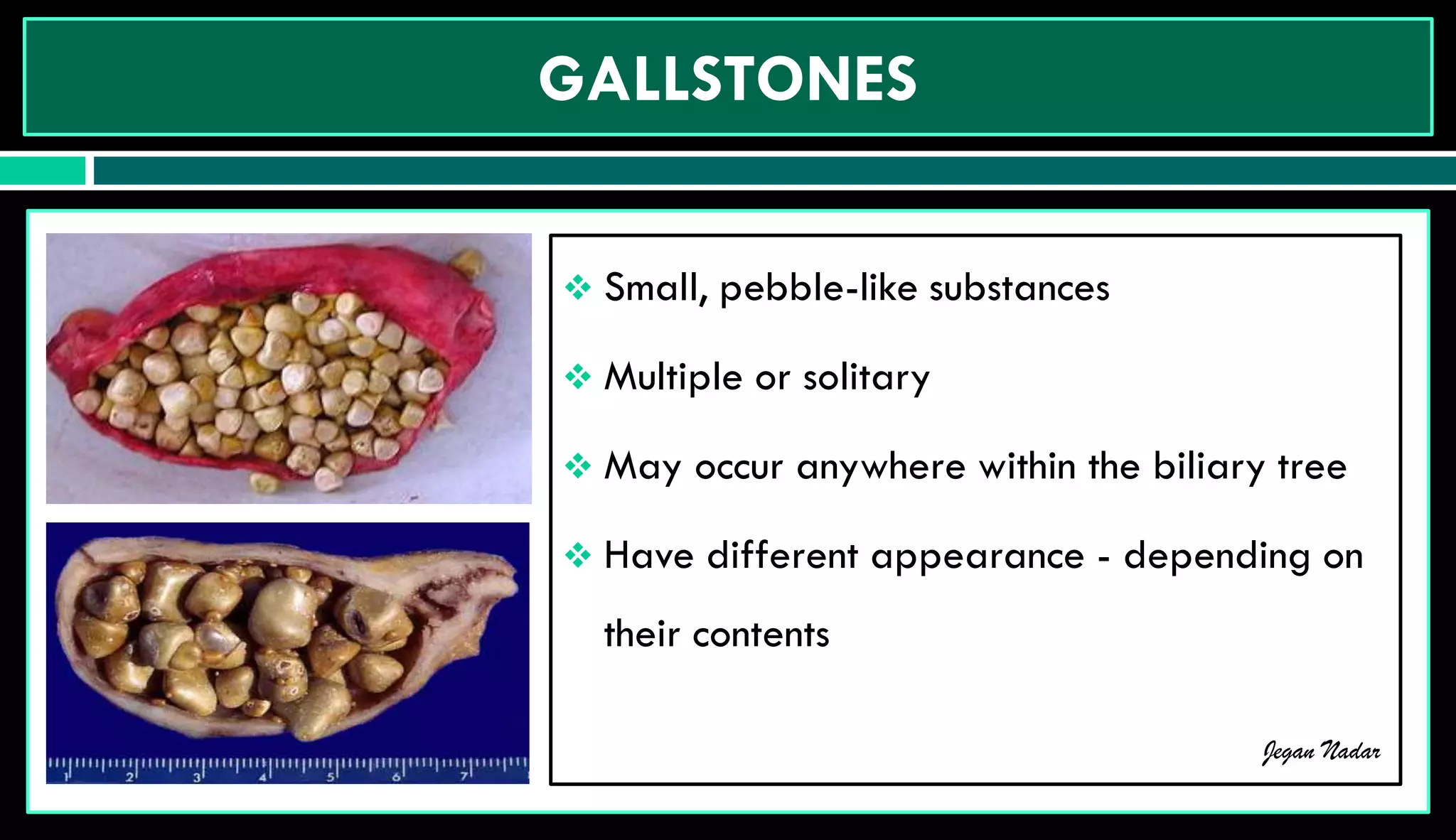 Pathophysiology of Cholecystitis and cholelithiasis | PDF