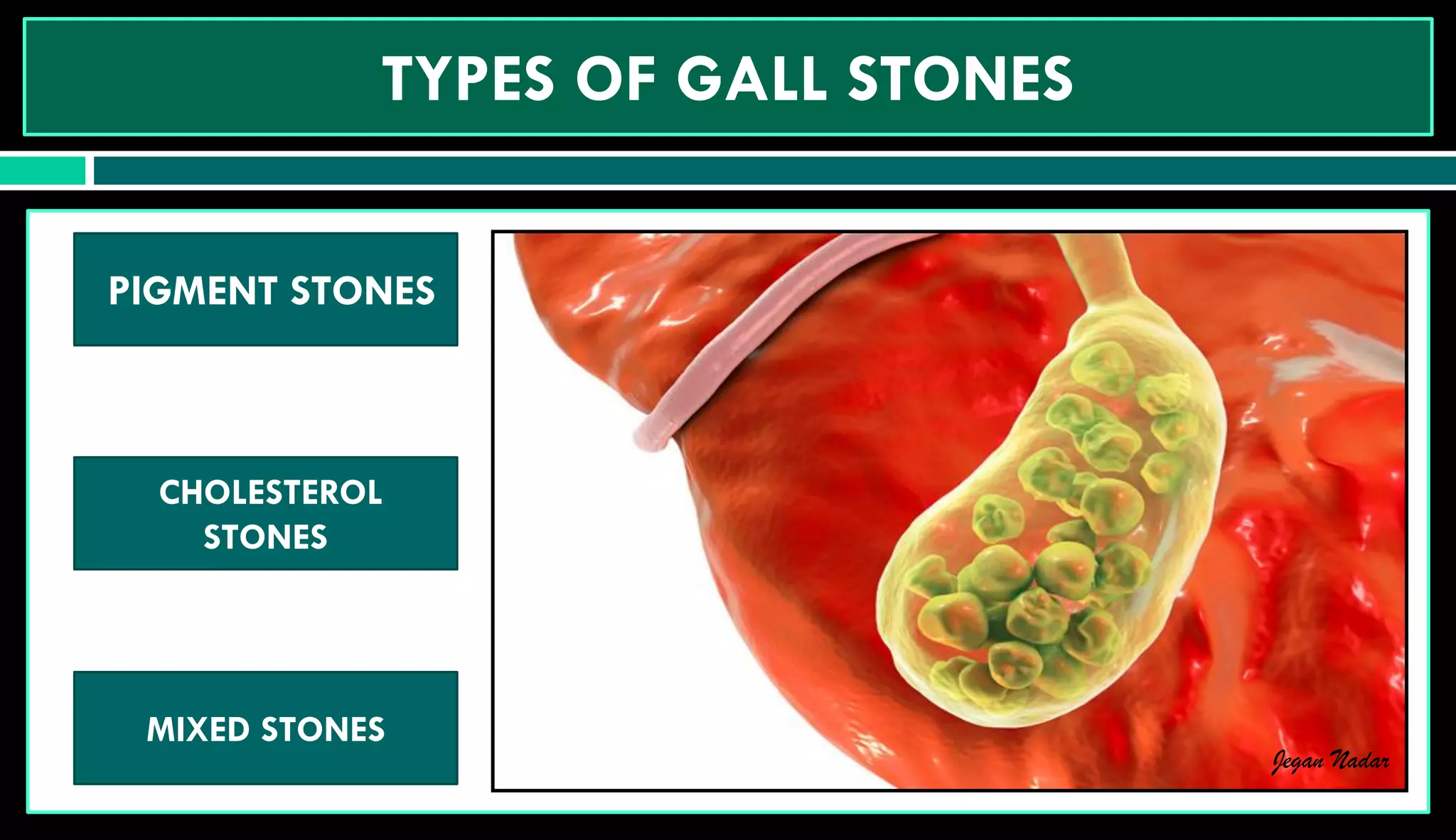 Pathophysiology of Cholecystitis and cholelithiasis | PDF