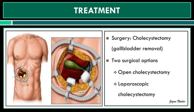 Pathophysiology of Cholecystitis and cholelithiasis | PDF | Digestive Disorders | Diseases and ...