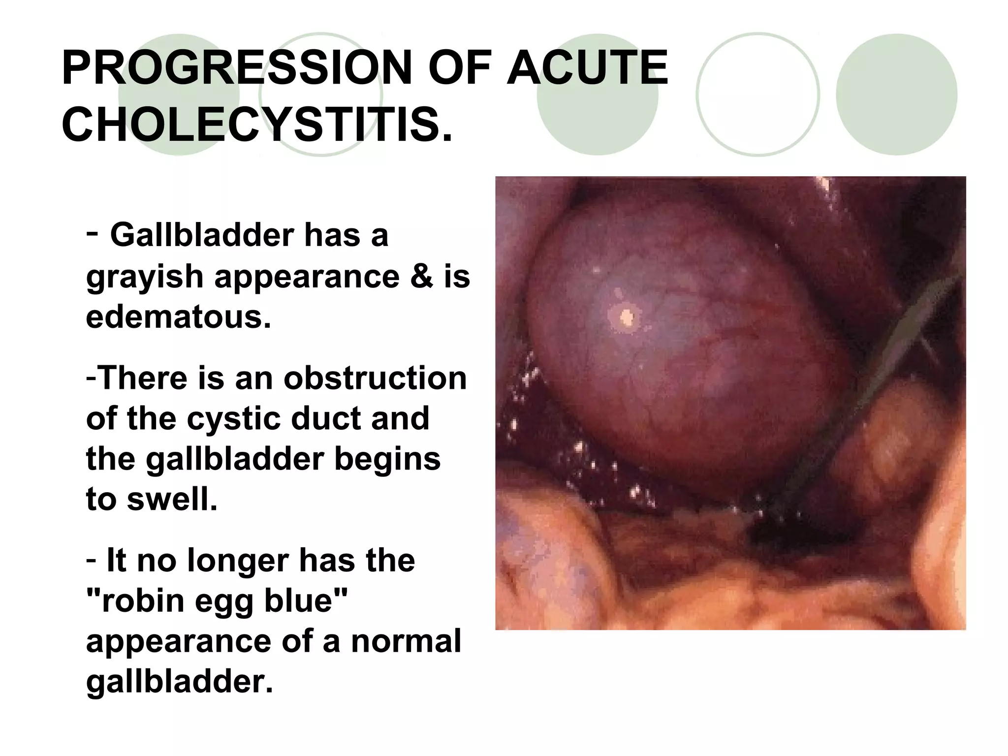 Cholecystitis cholelithiasis-presentation | PPT