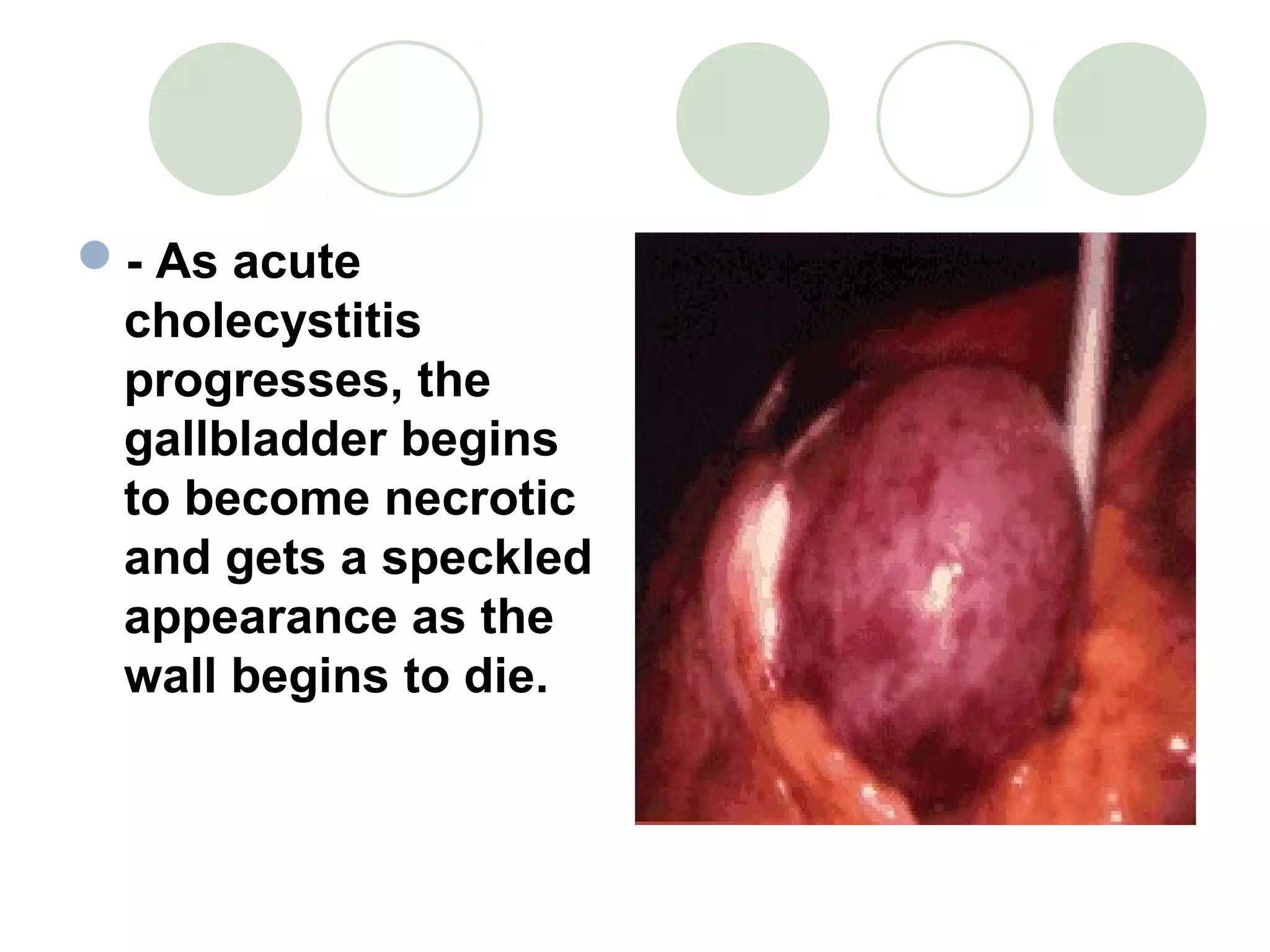 Cholecystitis cholelithiasis-presentation | PPT
