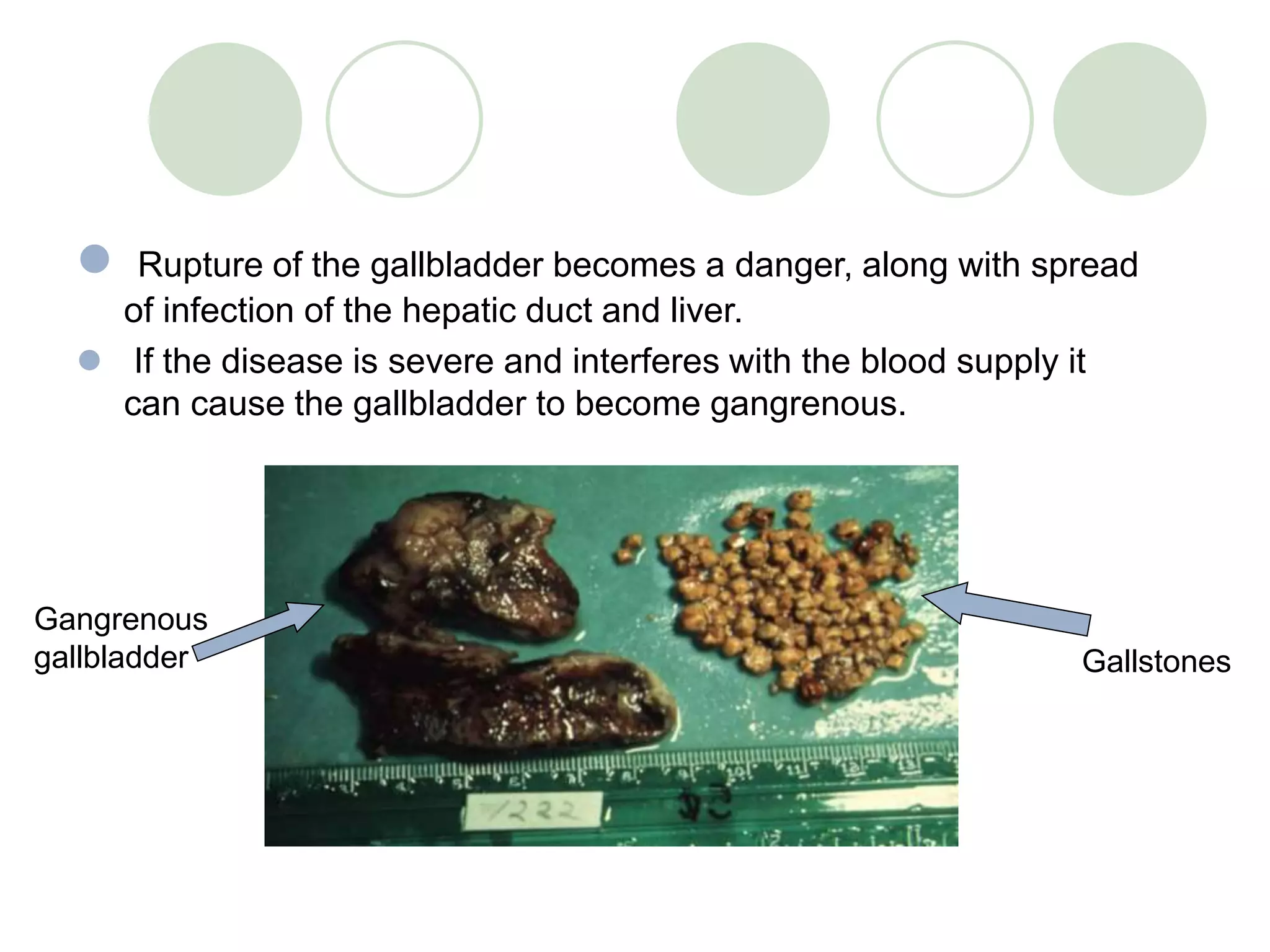 cholecystitis-cholelithiasis-presentation.ppt