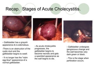 cholecystitis-cholelithiasis-presentation.ppt