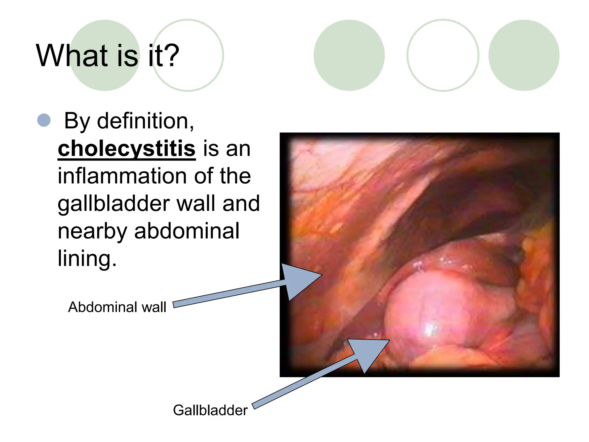 cholecystitis-cholelithiasis-presentation.ppt
