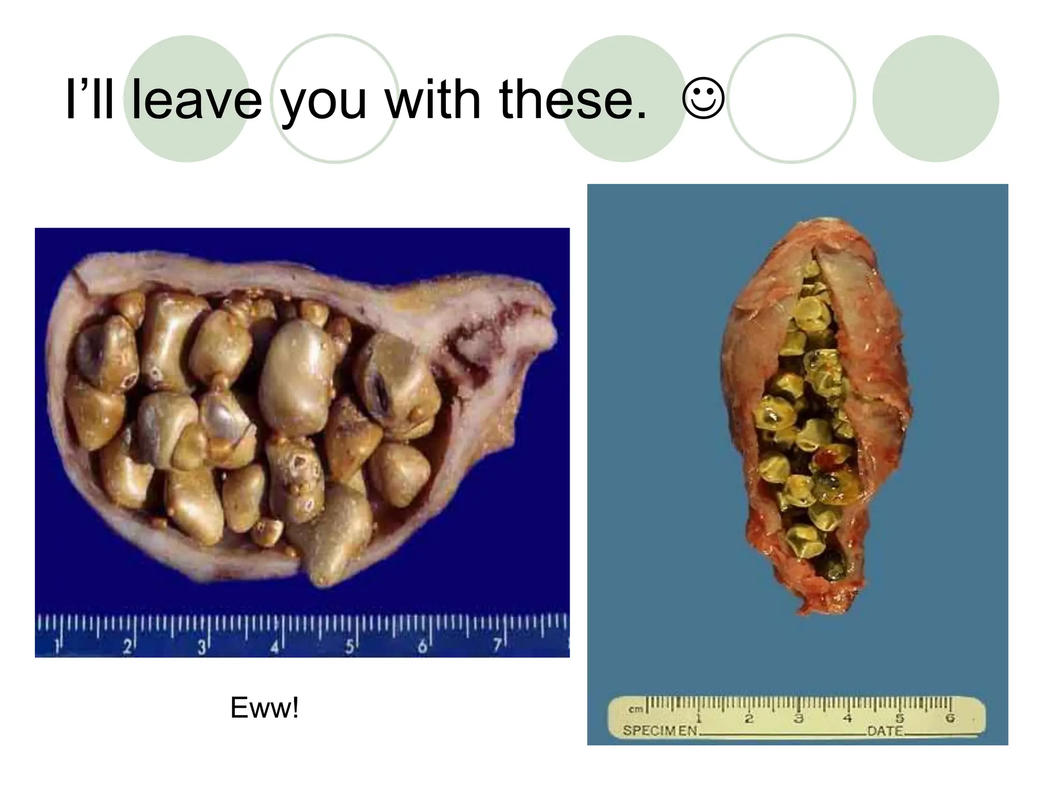 cholecystitis-cholelithiasis-presentation.ppt