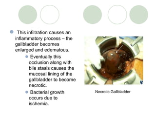 cholecystitis-cholelithiasis-presentation.ppt