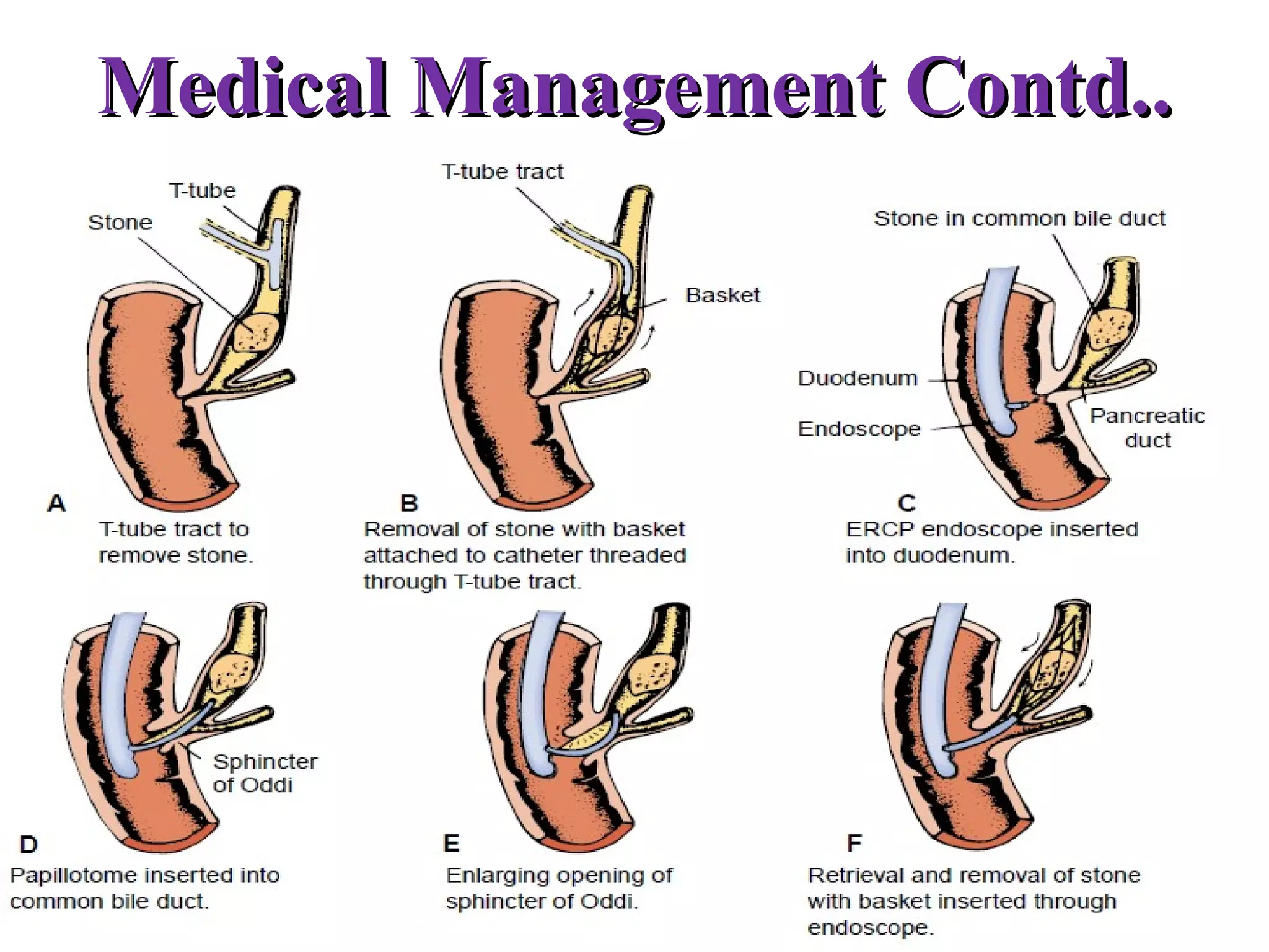 Cholecystitis and cholelithiasis | PPT