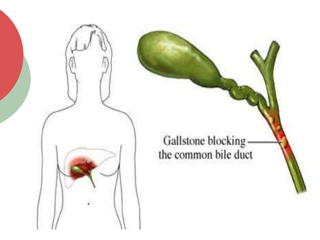 Cholecystitis And Cholelithiasis slideshare | PPTX | Digestive ...