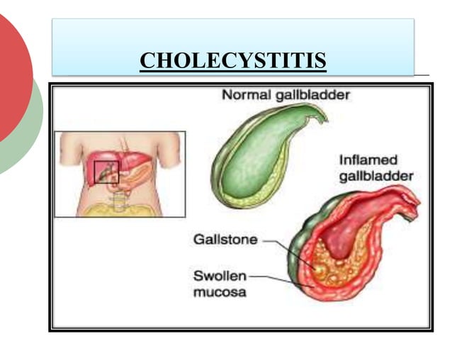 Cholecystitis And Cholelithiasis slideshare | PPTX | Digestive ...