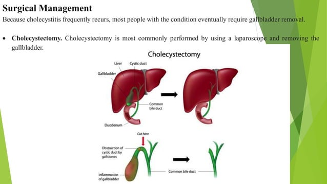 Cholecystitis ppt | PPTX