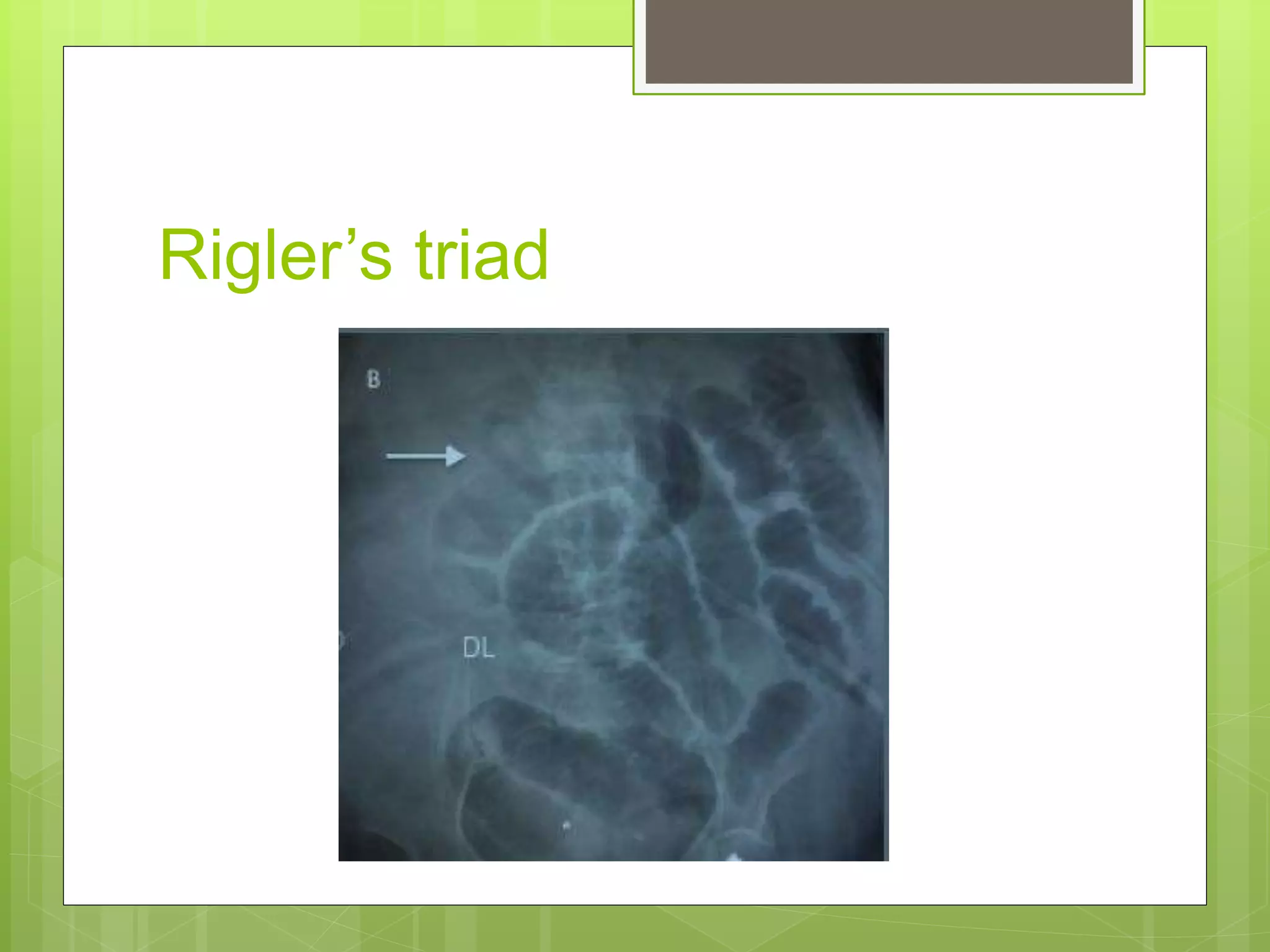 Cholecystogastric fistula | PPT | Free Download