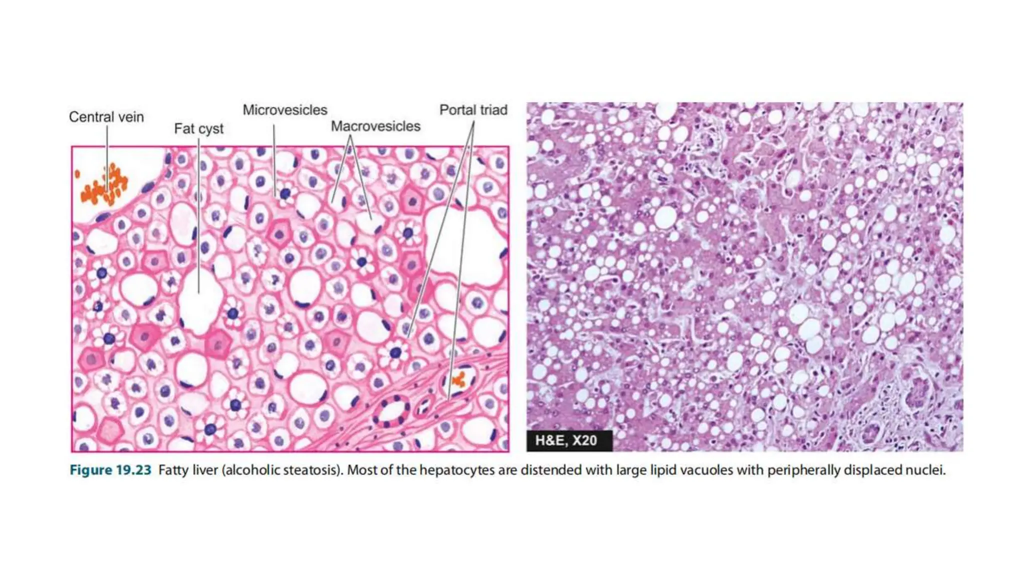 Cholecytitis pathology gall bladder.pptx