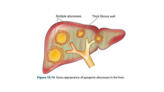 Cholecytitis pathology gall bladder.pptx | Digestive Disorders ...