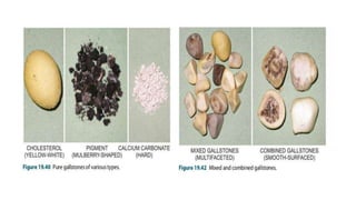 Cholecytitis pathology gall bladder.pptx | Digestive Disorders ...