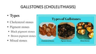 cholecytitis final.pptx