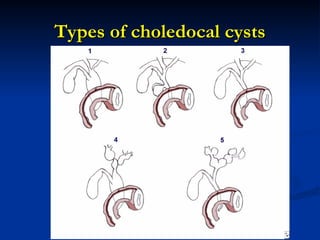 Choledochal cyst the lect. types and management | PPT