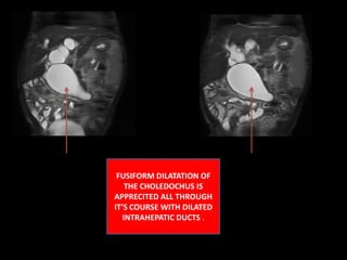Choledochal cyst | PPTX | Digestive Disorders | Diseases and Conditions