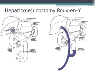 Choledochal cyst | PPT