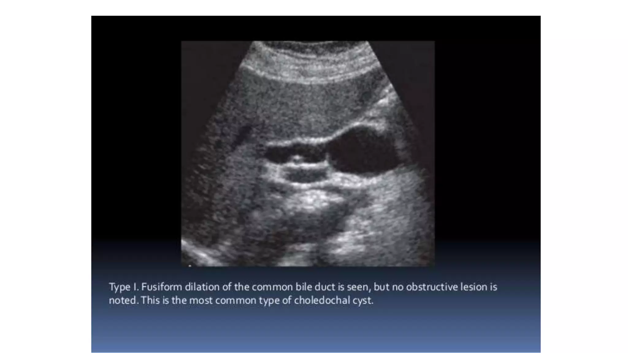 Choledochal cyst | PPTX