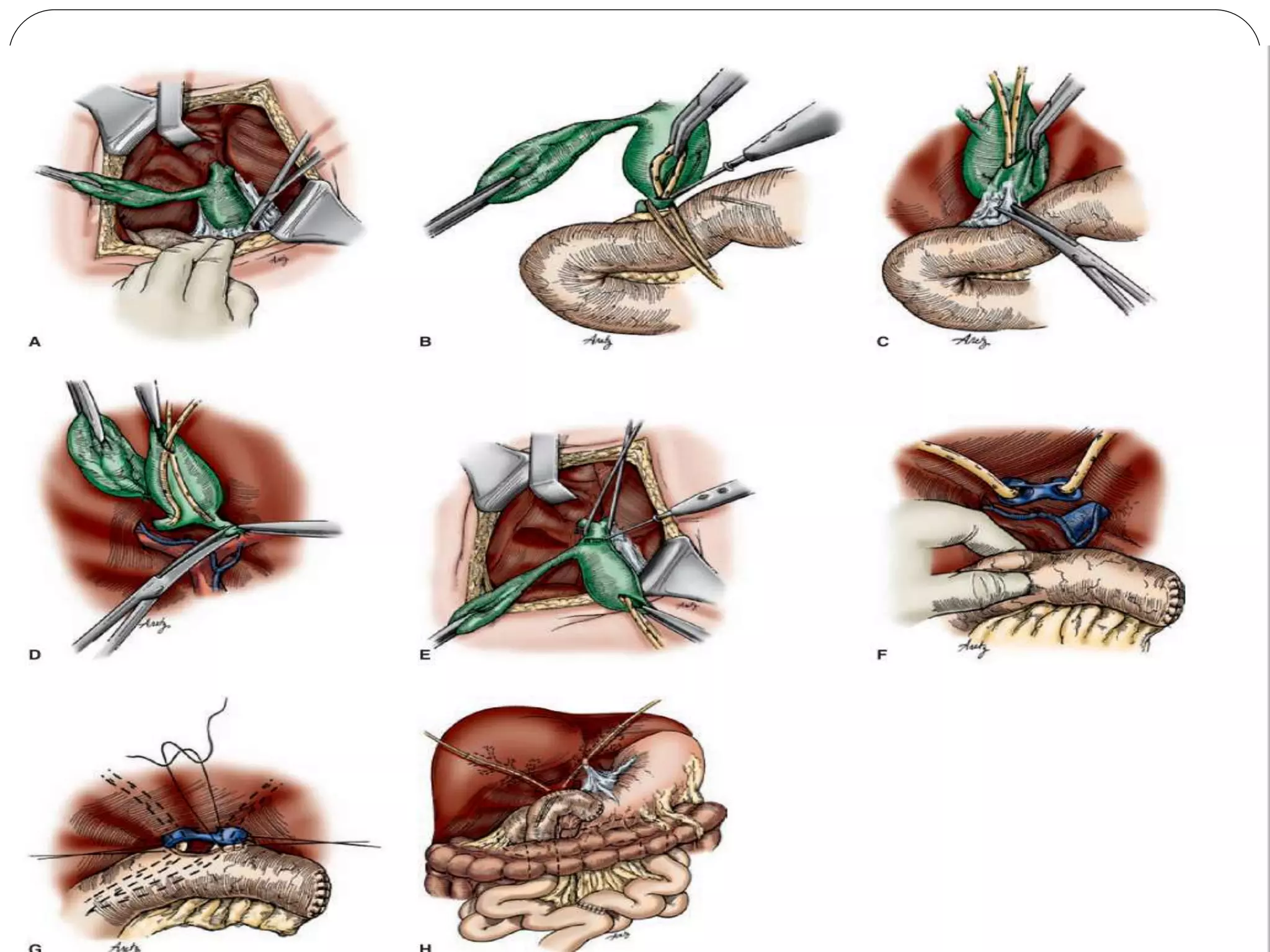 Choledochal cyst, biliary Cyst | PPTX