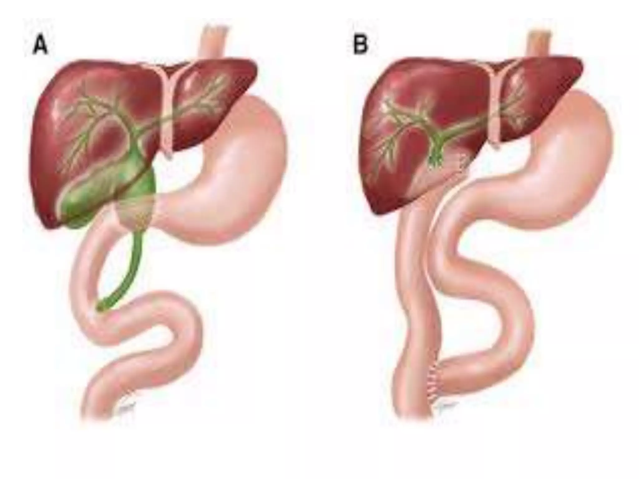 Choledochal cyst | PPTX