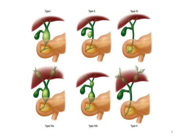 Choledochal cyst | PPTX