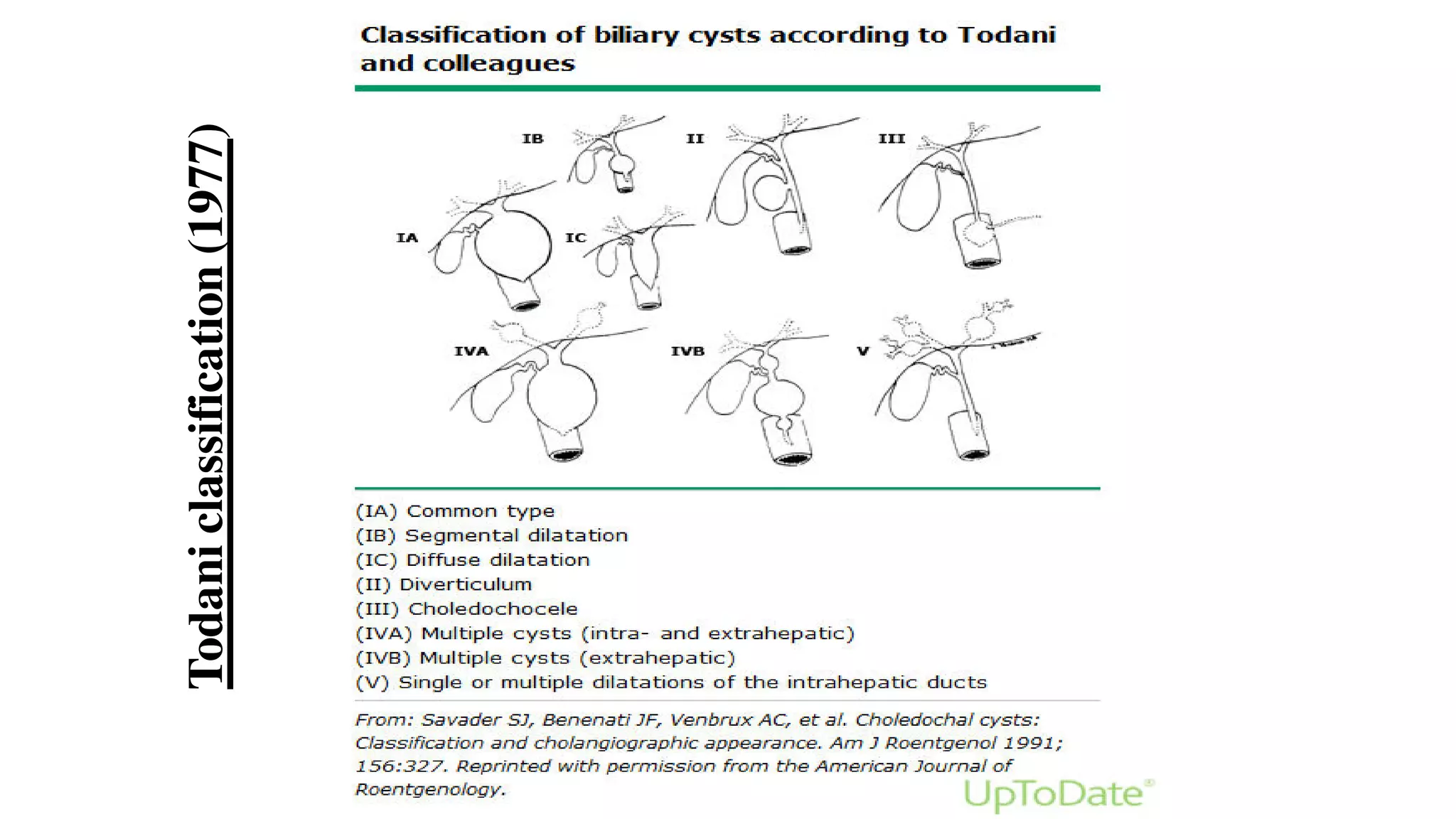Choledochal cyst | PDF