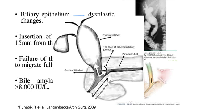 Choledochal cyst | PDF | Digestive Disorders | Diseases and Conditions