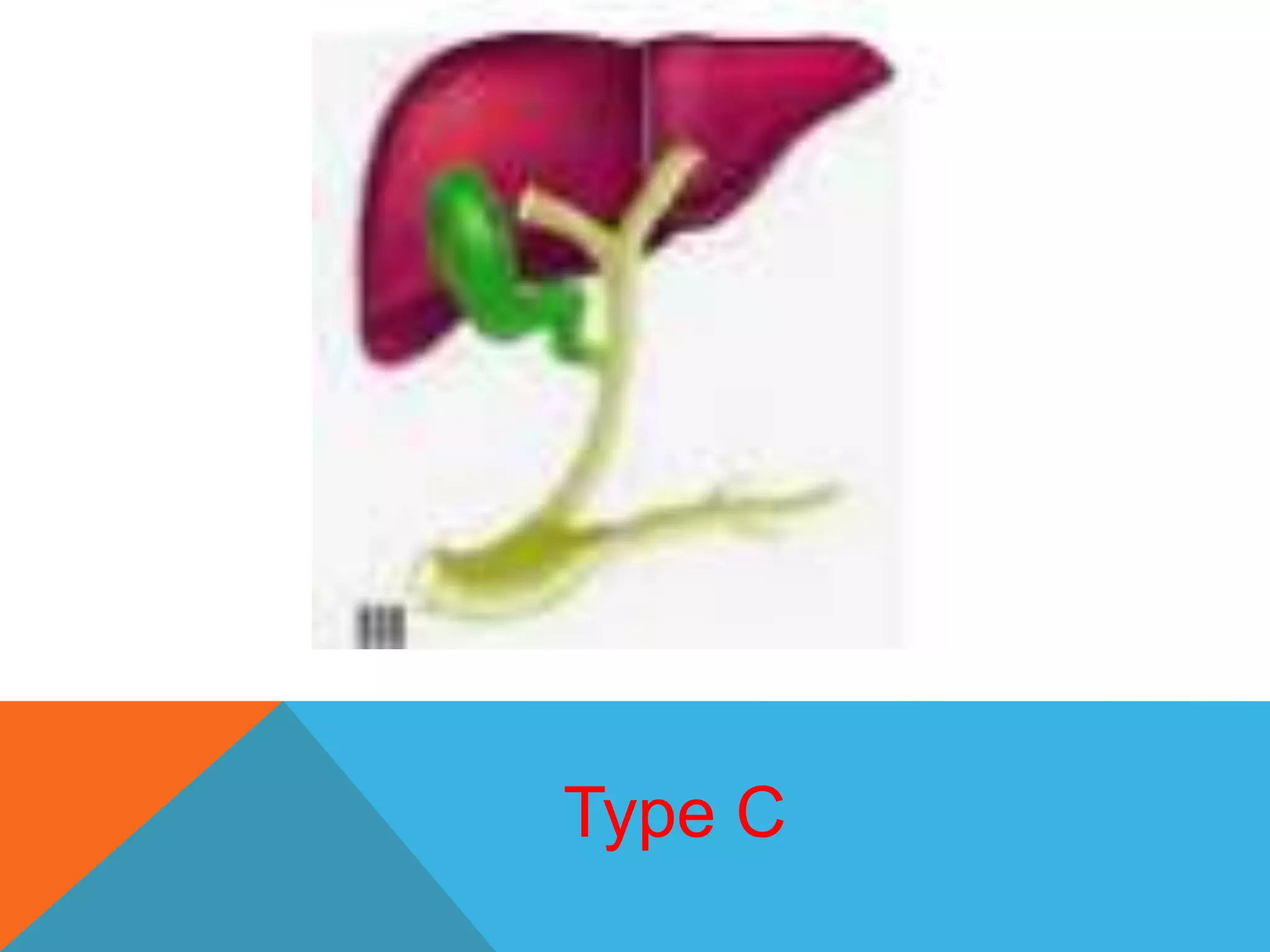 CHOLEDOCHAL CYST.pptx