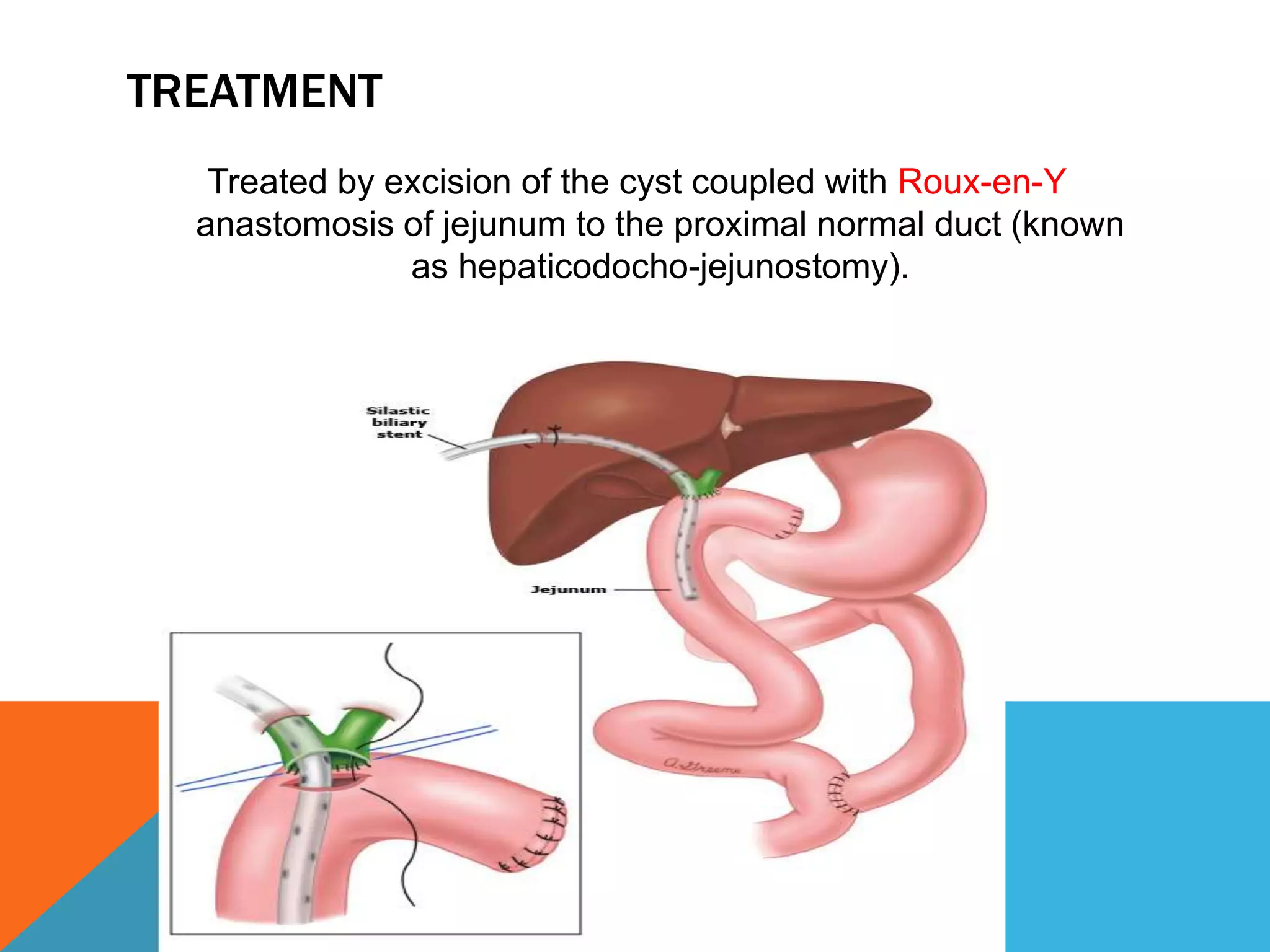 CHOLEDOCHAL CYST.pptx