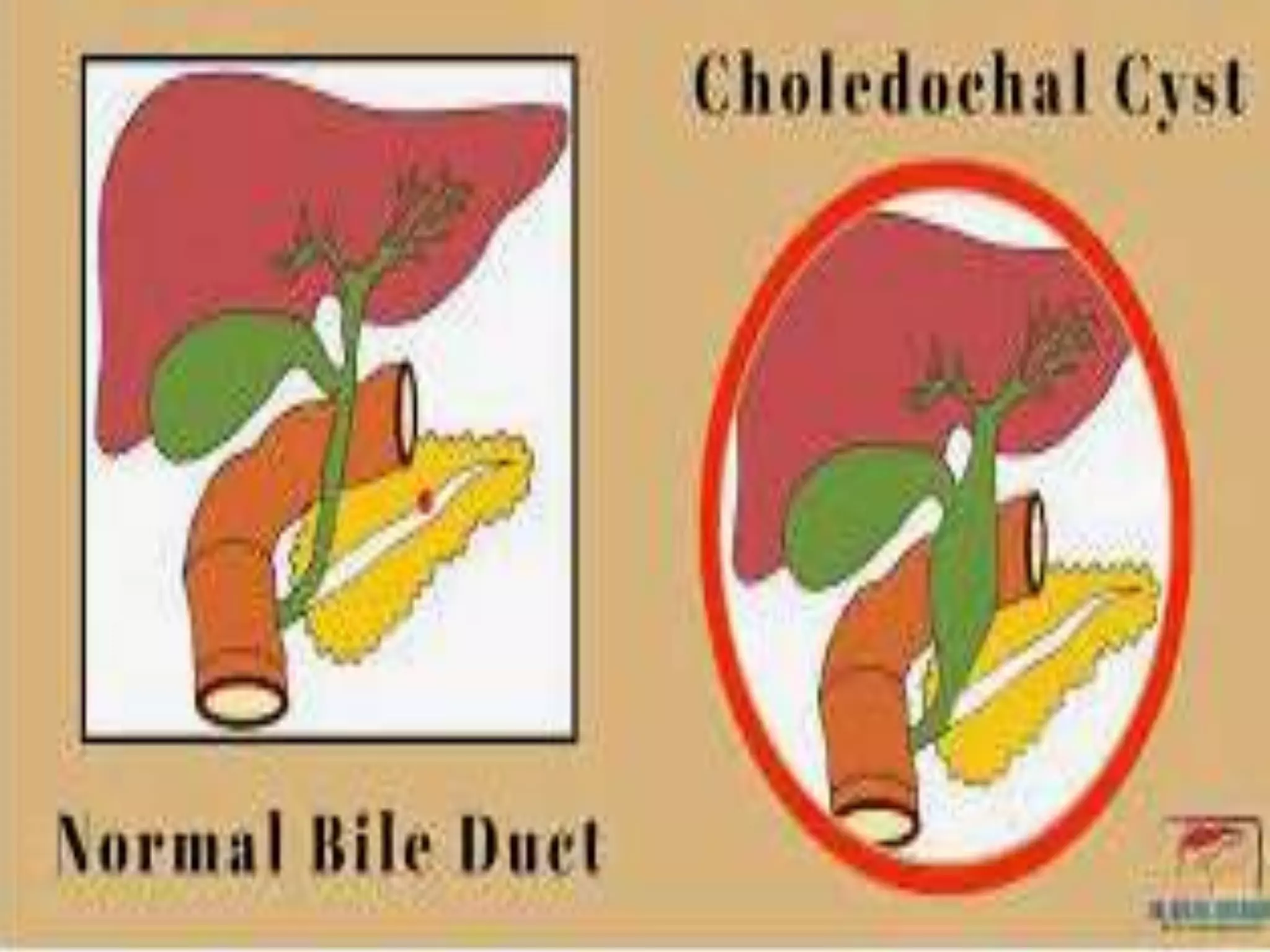 CHOLEDOCHAL CYST.pptx