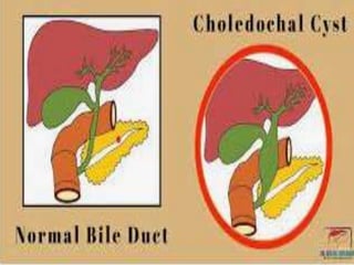 CHOLEDOCHAL CYST.pptx