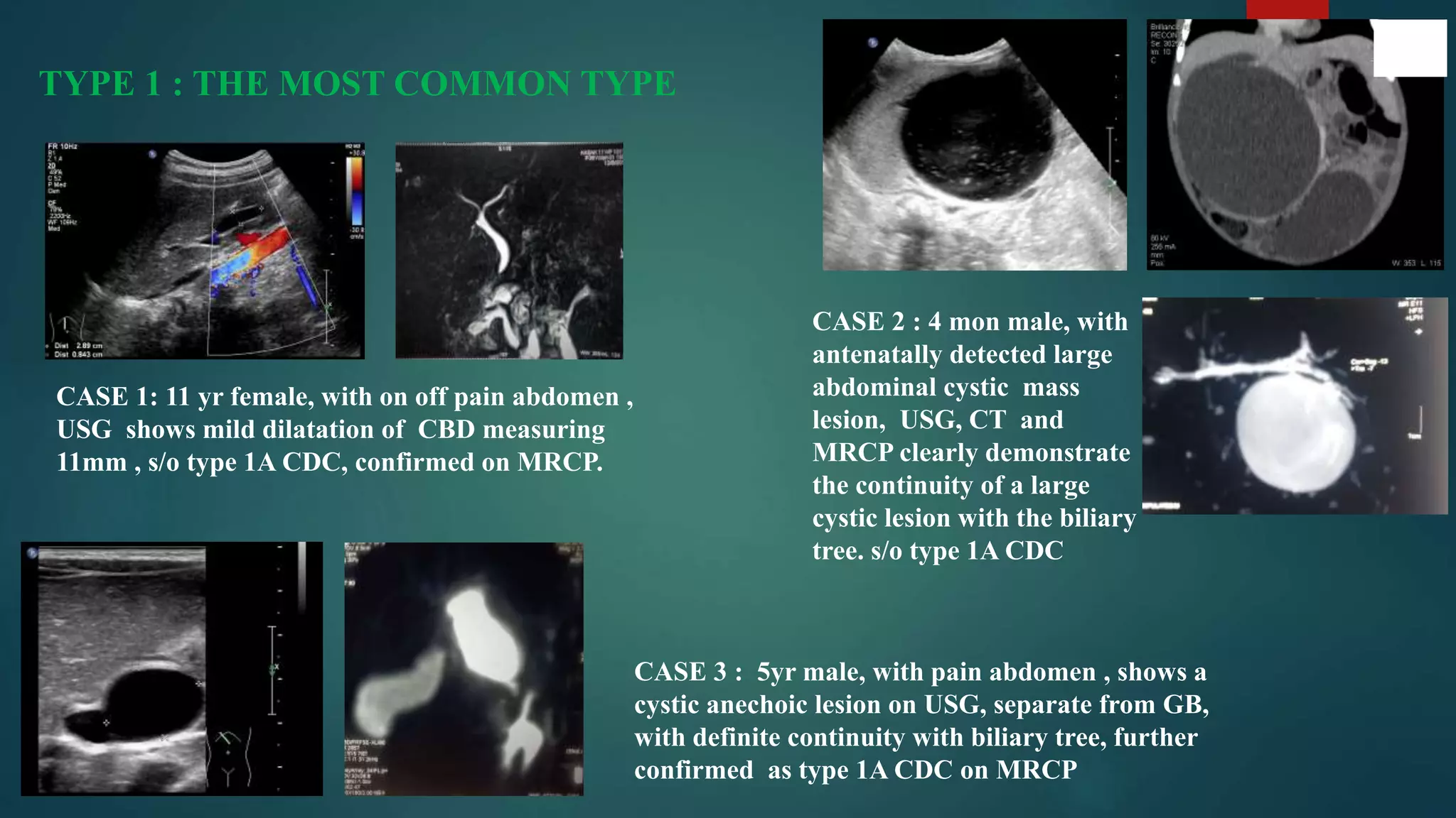Choledochal Cyst.pptx