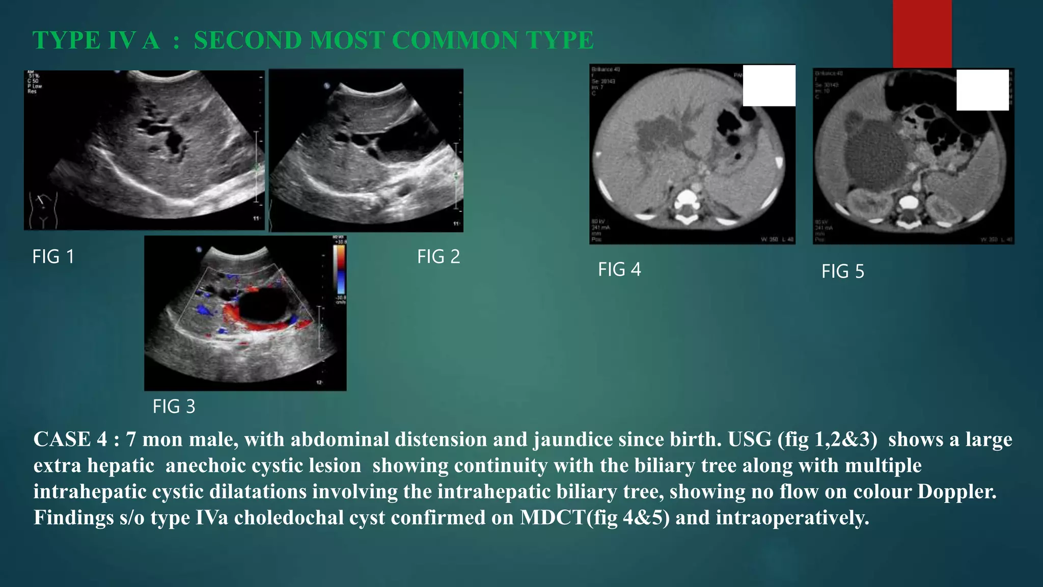 Choledochal Cyst.pptx