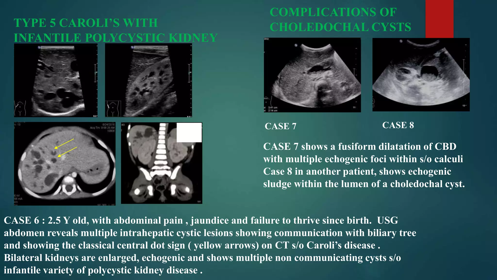 Choledochal Cyst.pptx