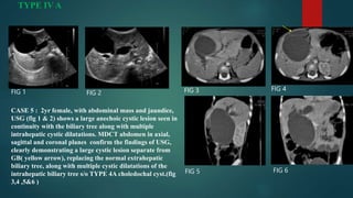 Choledochal Cyst.pptx