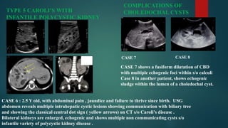 Choledochal Cyst.pptx