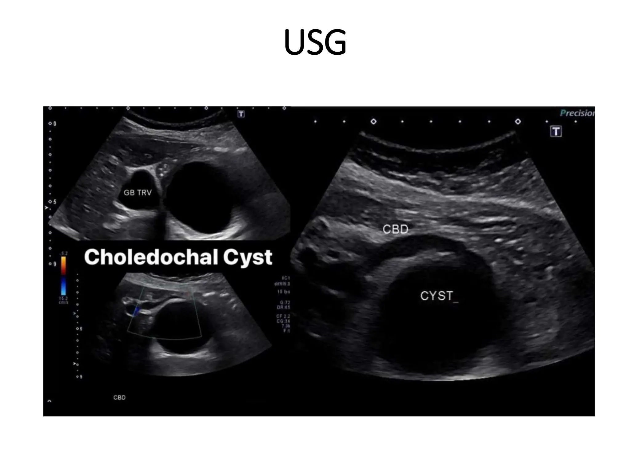 Choledochal cyst & Biliary atresia.pptx