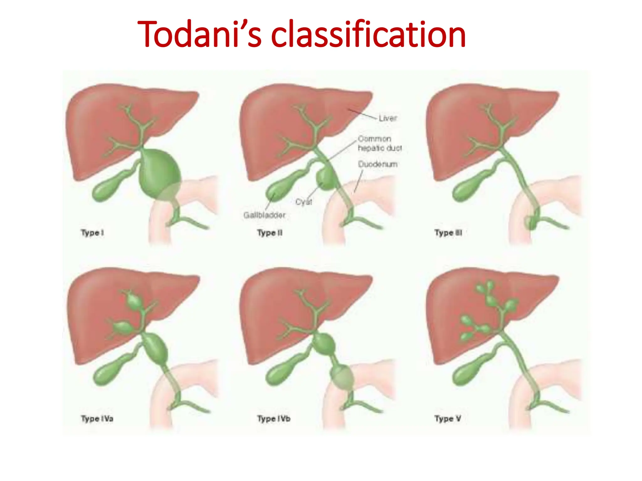 Choledochal cyst & Biliary atresia.pptx
