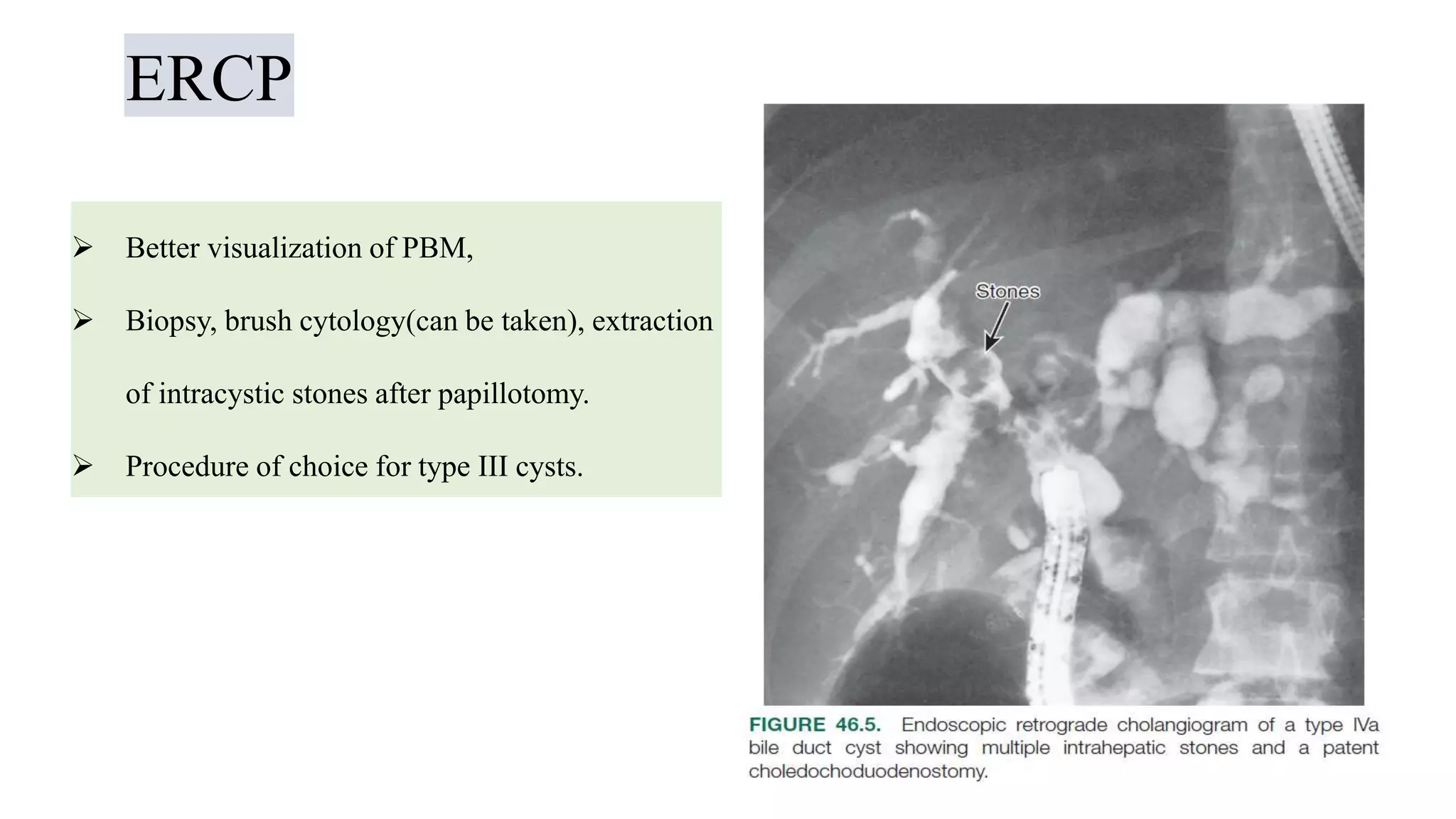 Choledochal cyst | PPTX