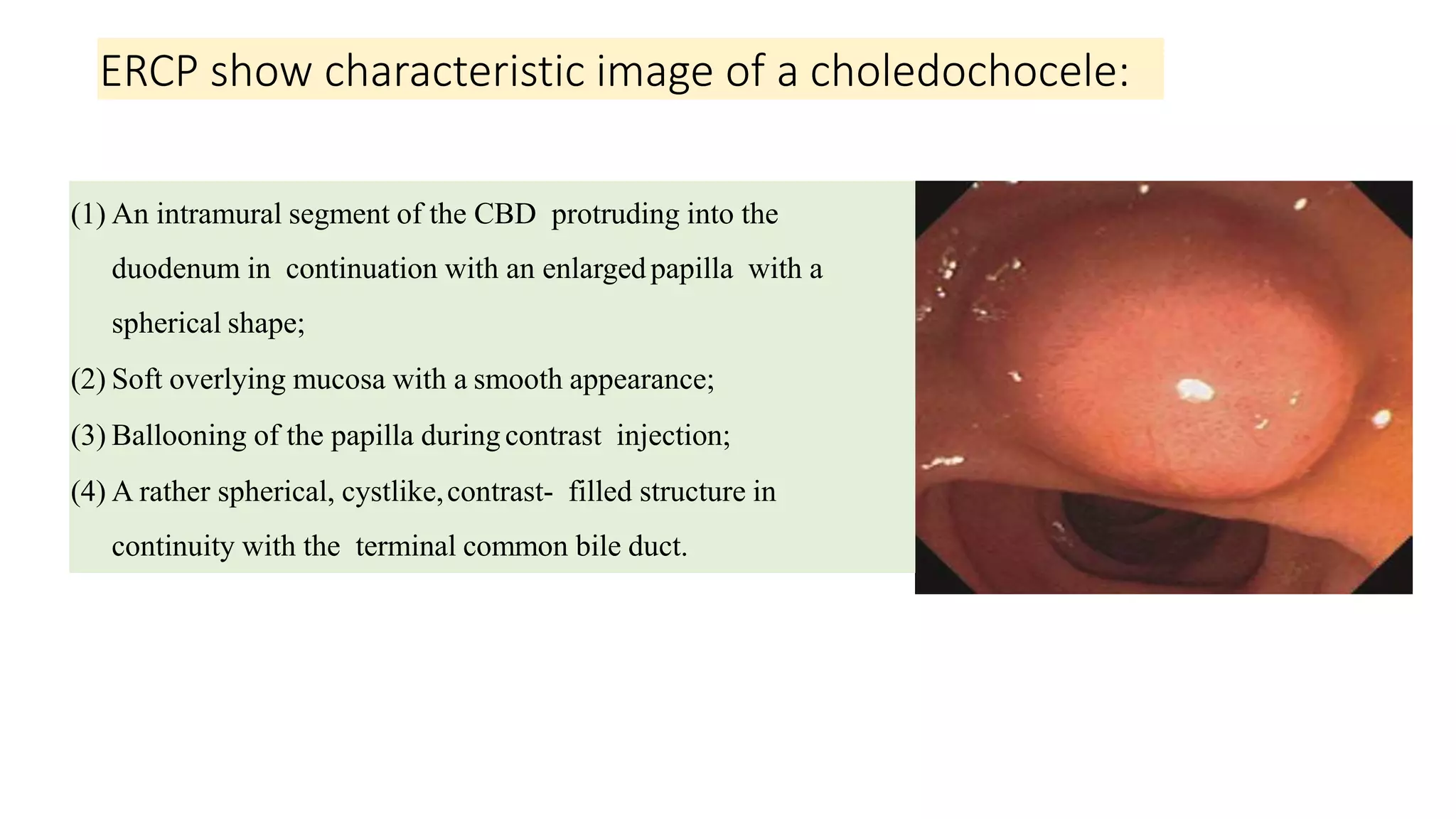 Choledochal cyst | PPTX