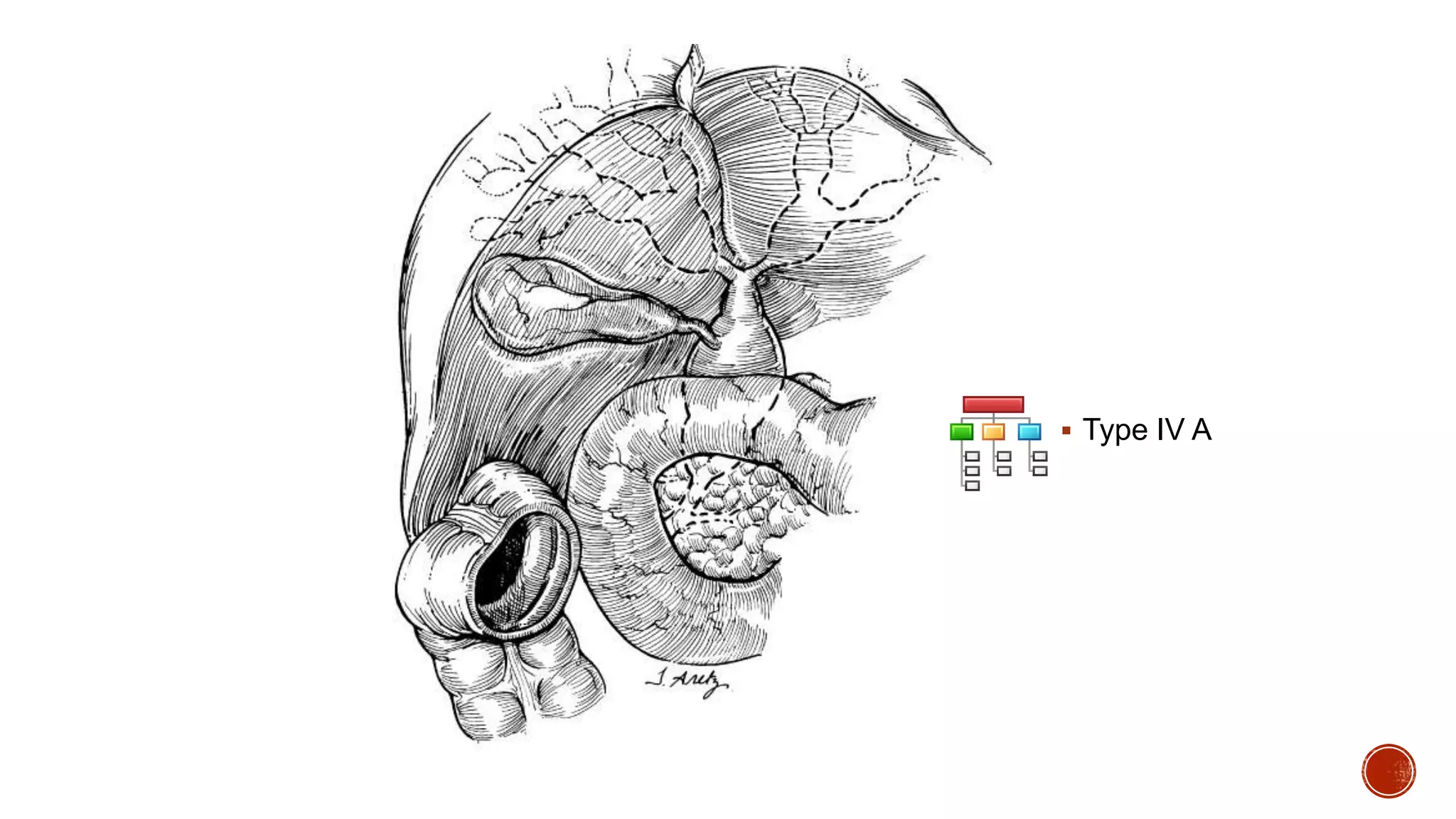 Choledochal cysts - Introduction, Classification, Pathogenesis ...