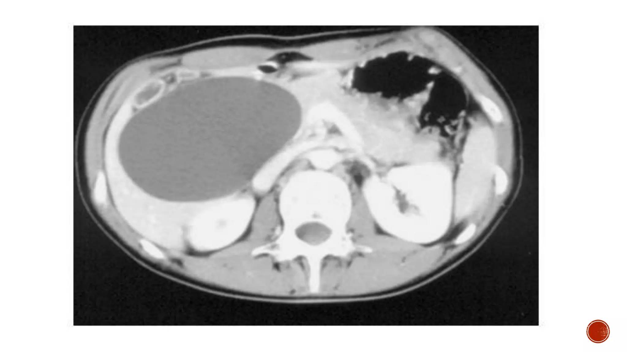 Choledochal cysts - Introduction, Classification, Pathogenesis ...