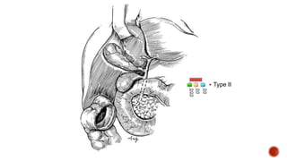Choledochal cysts - Introduction, Classification, Pathogenesis ...