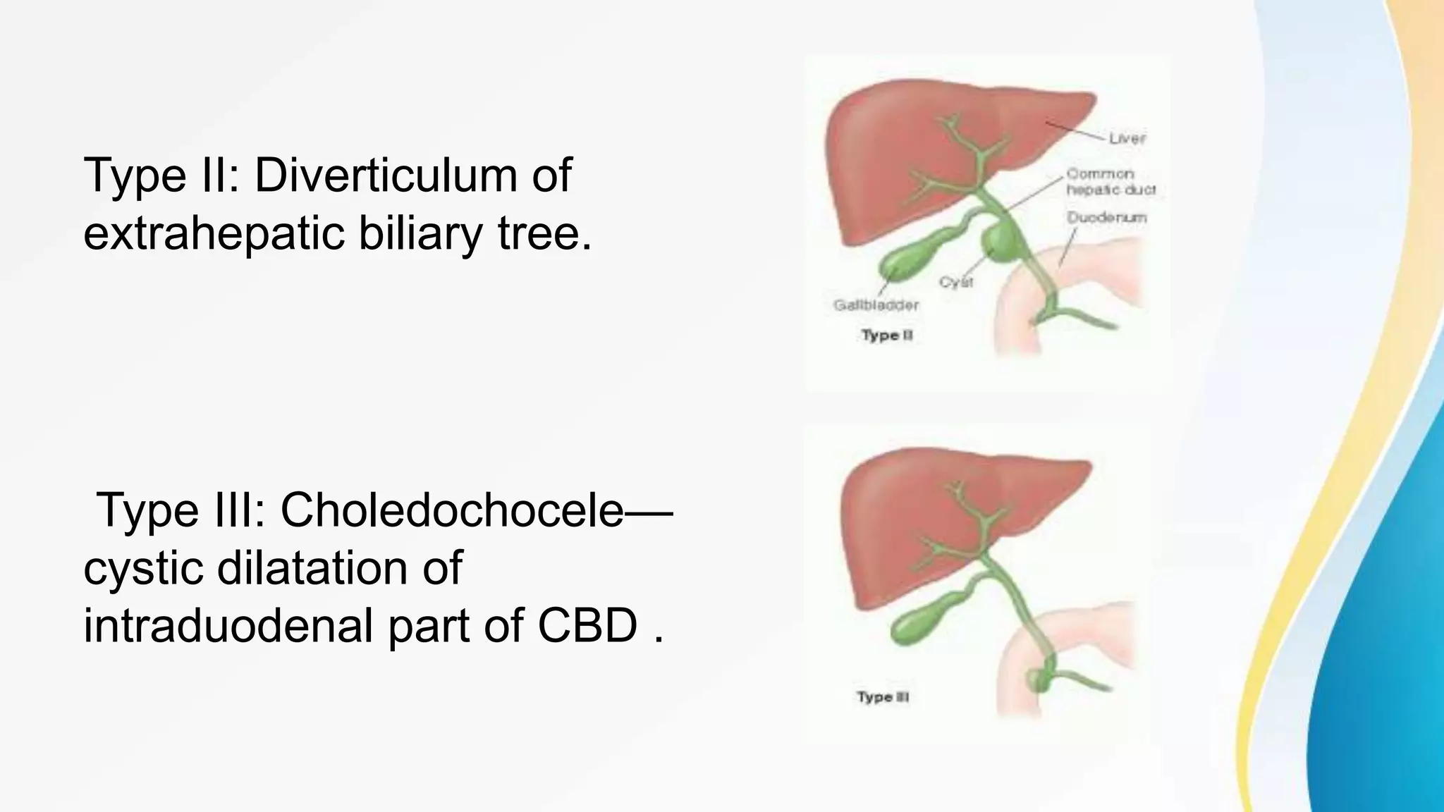 Choledochal cyst | PPTX