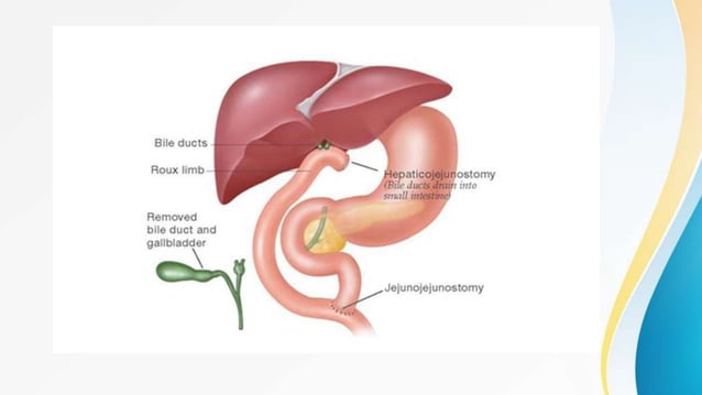 Choledochal cyst | PPTX | Digestive Disorders | Diseases and Conditions