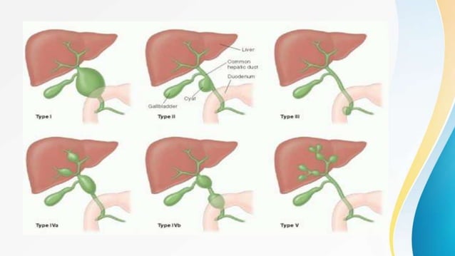 Choledochal cyst | PPTX | Digestive Disorders | Diseases and Conditions